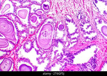 Micrograph of prostatic hyperplasia, showing increased glandular tissue ...
