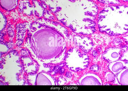 Micrograph of prostatic hyperplasia, showing increased glandular tissue ...