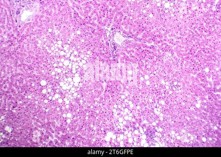 Photomicrograph of hepatic steatosis, revealing fat accumulation in ...