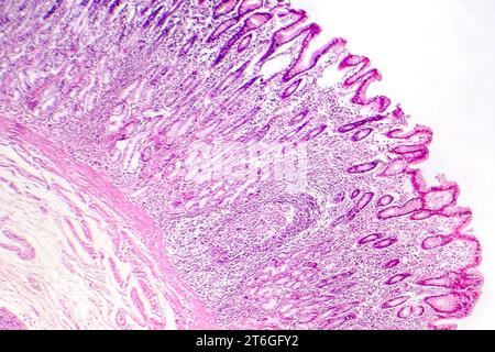 Photomicrograph of intestinal metaplasia, displaying transformation of ...