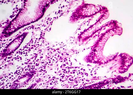 Photomicrograph of intestinal metaplasia, displaying transformation of ...