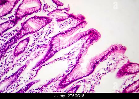 Photomicrograph of intestinal metaplasia, displaying transformation of ...