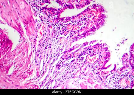 Photomicrograph of chronic cholecystitis, showcasing inflammation and ...