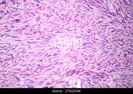Photomicrograph of leiomyosarcoma, depicting malignant smooth muscle ...