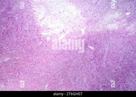 Photomicrograph of leiomyosarcoma, depicting malignant smooth muscle ...