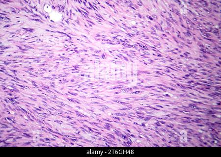 Photomicrograph of leiomyosarcoma, depicting malignant smooth muscle ...