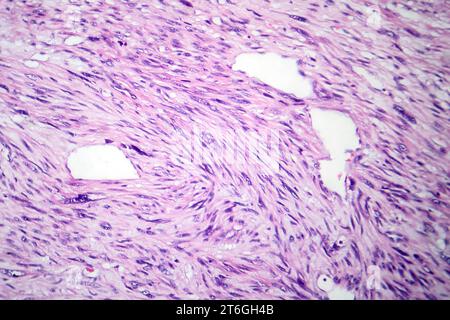 Photomicrograph of leiomyosarcoma, depicting malignant smooth muscle ...