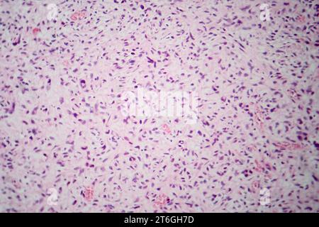 Photomicrograph of malignant cells, revealing abnormal and uncontrolled ...