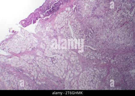 Photomicrograph of mucinous carcinoma in the stomach, displaying ...