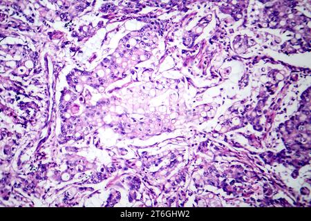 Photomicrograph of mucinous carcinoma in the stomach, displaying ...