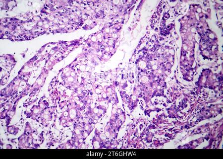 Photomicrograph of mucinous carcinoma in the stomach, displaying ...