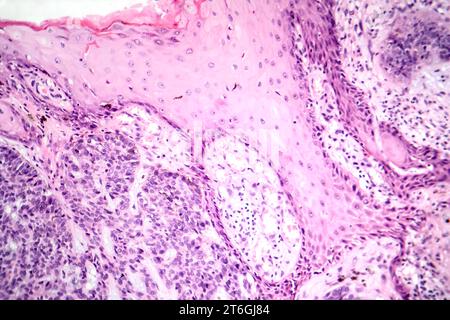 Photomicrograph of basal cell carcinoma, displaying malignant basal ...