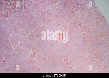Photomicrograph of capillary hemangioma, illustrating abnormal ...