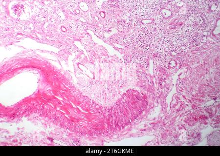 Photomicrograph of primary particulate contracted kidney, illustrating ...