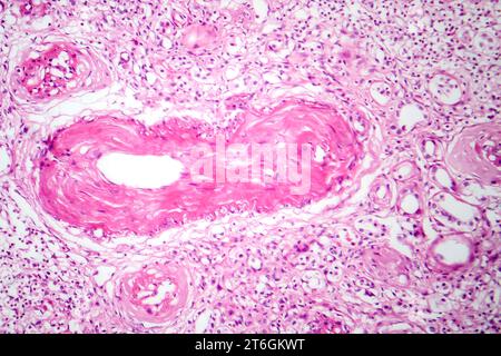 Photomicrograph of primary particulate contracted kidney, illustrating ...