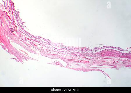 Photomicrograph of chronic bronchitis, showing inflamed bronchial ...