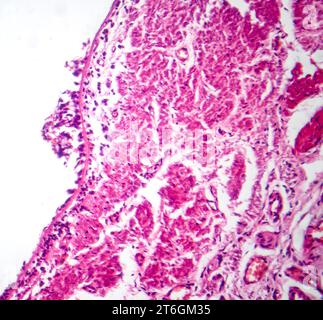 Photomicrograph of chronic bronchitis, showing inflamed bronchial ...