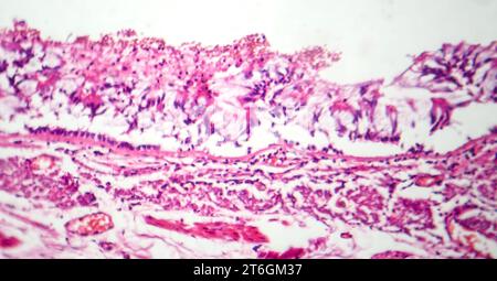 Photomicrograph of chronic bronchitis, showing inflamed bronchial ...