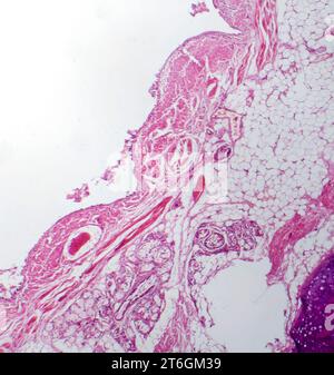 Photomicrograph of chronic bronchitis, showing inflamed bronchial ...