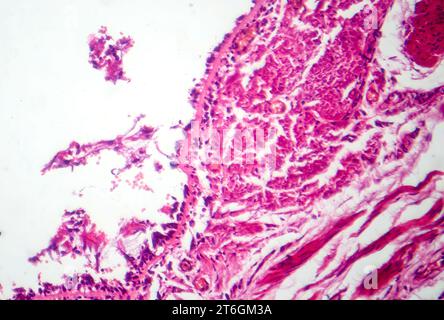 Photomicrograph of chronic bronchitis, showing inflamed bronchial ...