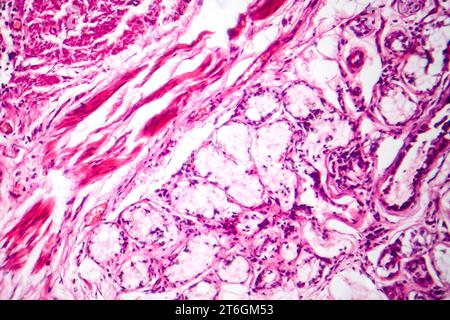 Photomicrograph of chronic bronchitis, showing inflamed bronchial ...