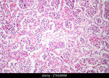 Photomicrograph of lobar pneumonia in red hepatic phase, displaying ...