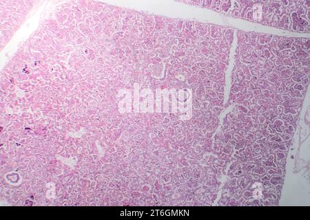 Photomicrograph of lobar pneumonia in red hepatic phase, displaying ...