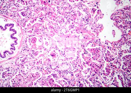 Photomicrograph of lobar pneumonia in red hepatic phase, displaying ...