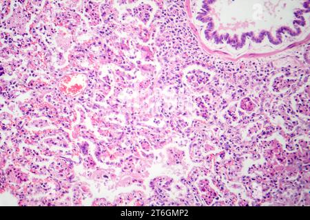Photomicrograph of lobar pneumonia in red hepatic phase, displaying ...