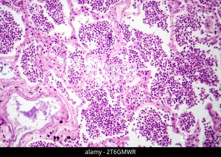 Photomicrograph of lobar pneumonia in grey hepatic phase, revealing ...