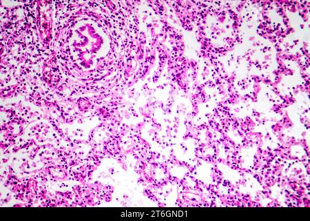 Photomicrograph of bronchopneumonia, illustrating inflammation and ...