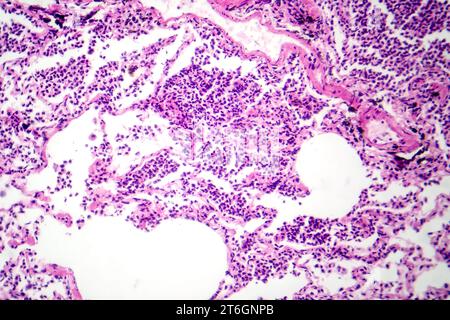 Photomicrograph of interstitial pneumonia, showing inflammation and ...