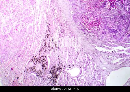 Photomicrograph of squamous cell carcinoma of the lung, showing ...