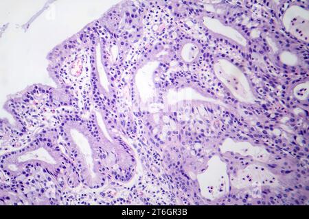 Photomicrograph of nasal polyps, displaying abnormal tissue growth in ...