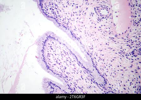 Photomicrograph of nasal polyps, displaying abnormal tissue growth in ...