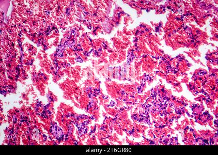 Photomicrograph of acute pulmonary hemorrhage, showing blood-filled ...