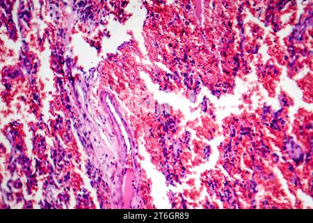 Photomicrograph of acute pulmonary hemorrhage, showing blood-filled ...
