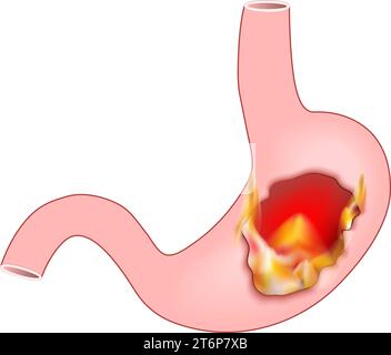 Esophageal gastric reflux acid indigestion. Gastrointestial stomach ...