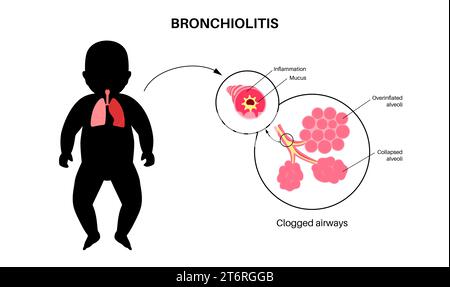 Bronchiolitis lung disease, illustration Stock Photo - Alamy