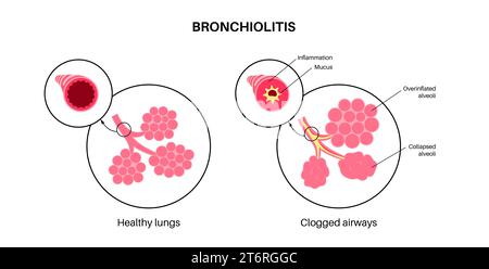 Bronchiolitis lung disease, illustration Stock Photo - Alamy