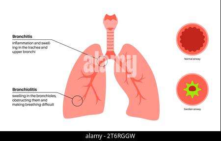 Bronchitis and bronchiolitis, illustration Stock Photo - Alamy
