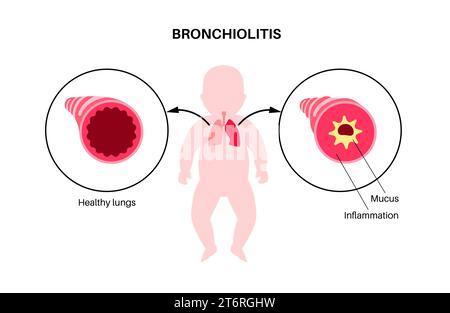 Bronchiolitis lung disease, illustration Stock Photo - Alamy