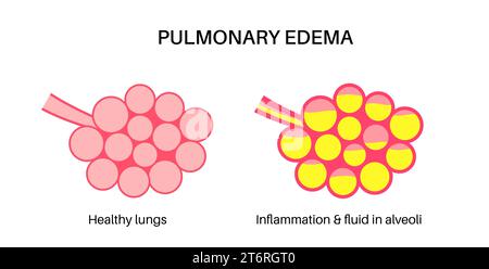 Pulmonary oedema, illustration Stock Photo - Alamy