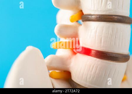 Model of the lumbar spine with a red intervertebral hernia and ...