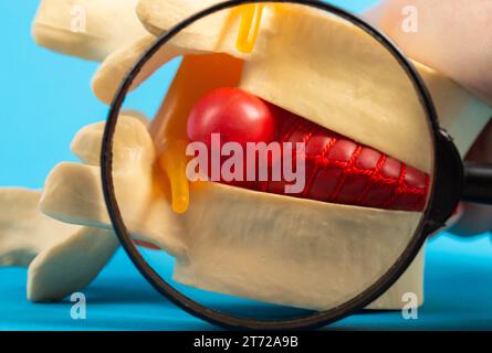 Inflamed red herniated disc of the spine under a magnifying glass ...