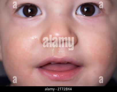 Bacterial diseases in the nose. Yellow snot from the nose of a little ...