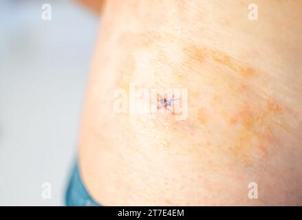Hip and leg with wound and stitches showing wound healing phases Stock ...