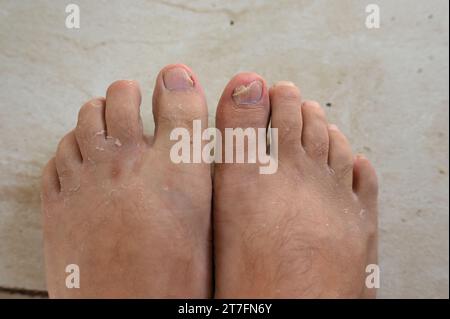 Fungus of nails on the big toe - dermatomycosis and onychomycosis ...
