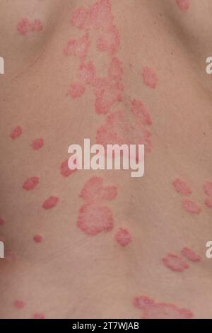 Psoriasis Vulgaris, skin patches are typically red, itchy, and scaly ...