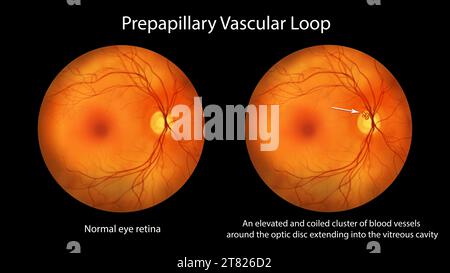Illustration of a prepapillary vascular loop on the retina, as observed ...